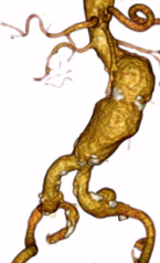 Gefährliche Aussackungen der Bauchschlagader